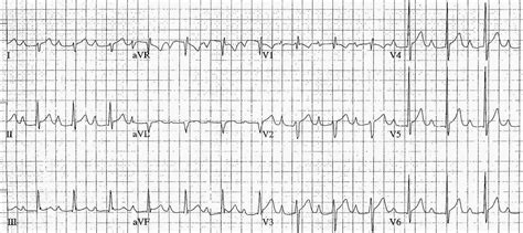 Rsr Ekg