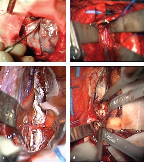 19 Corpus Callosotomy Neupsy Key