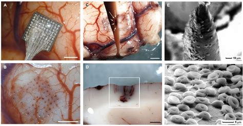 Acute Human Brain Responses To Intracortical Microelectrode Arrays