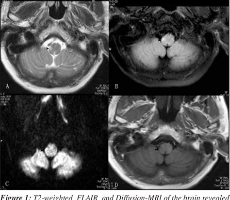 Figure 1 From The Canadian Journal Of Neurological Sciences Semantic