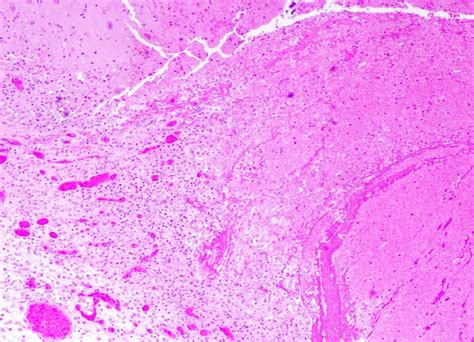 Diffuse Axonal Injury Histology