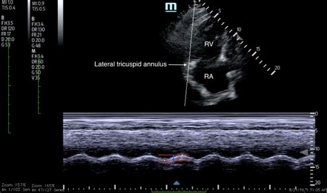 How To Do Tapse In Echo At Fernando Smith Blog