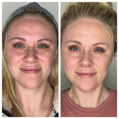 How To Achieve “glowing Goddess” Skin Results With Vi Peel And Botox In 7