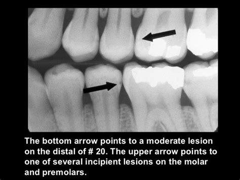 Radiographic Caries Diagnosis