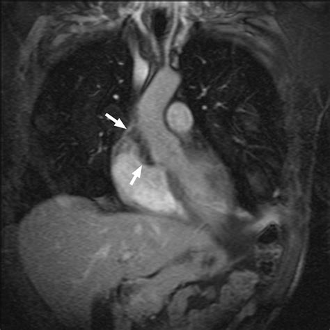 Mri Of Mycotic Sinus Of Valsalva Pseudoaneurysm Secondary To