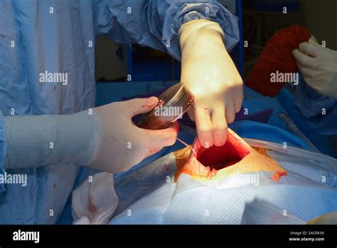 Multiple Sclerosis Baclofen Pump Therapy Surgeon Carrying Out An