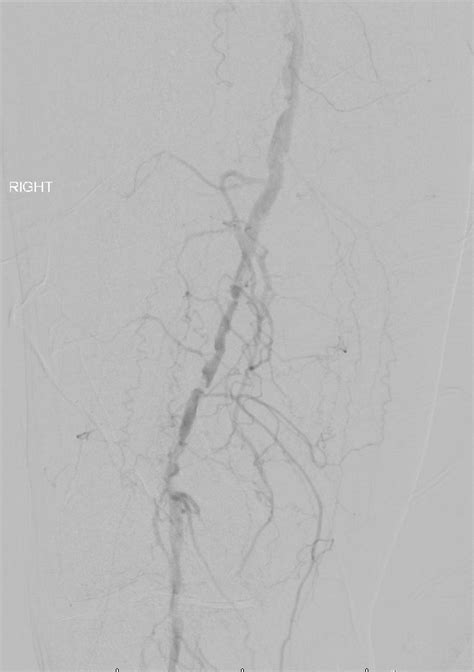 Anthony Feghali On Linkedin Vascularsurgery Upstateny Suny