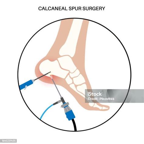Heel Spur Surgery Stock Illustration Download Image Now Calcaneus