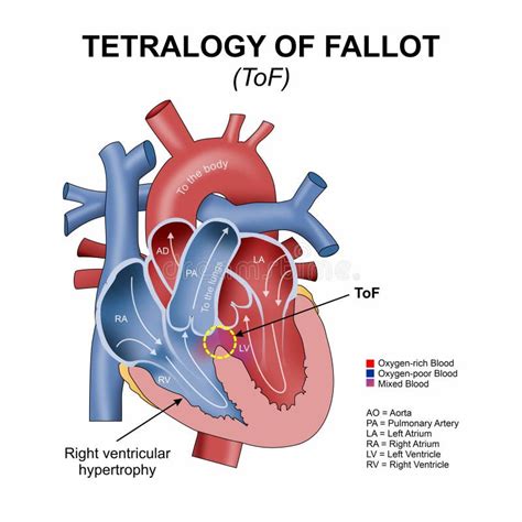 Tetralogy Of Fallot Tof Heart Flashcard Stock Illustration
