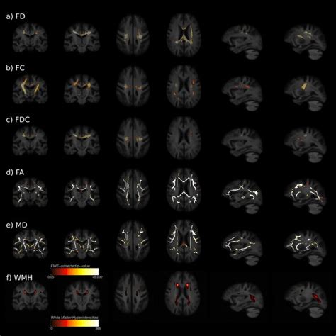 Whole Brain Clinical Fixel Based Analysis And Tbss Fixels And Voxels Download Scientific