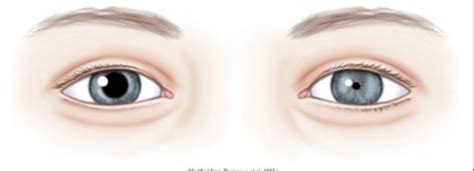 Pupillary Abnormalities Flashcards Quizlet