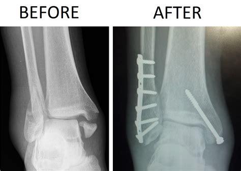 The Value Of Trimalleolar Ankle Fractures Peter Defilippis