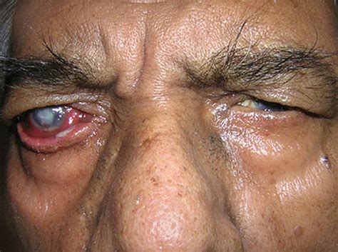 Punctate Epithelial Erosion