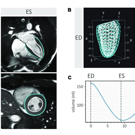 Image Analysis And 3d Left Ventricle Lv Geometry Extraction From