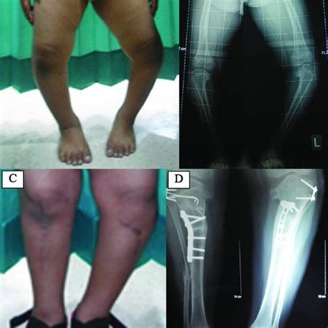 8 Year Old Male Patient With Bilateral Early Onset Blount Disease Left Download Scientific