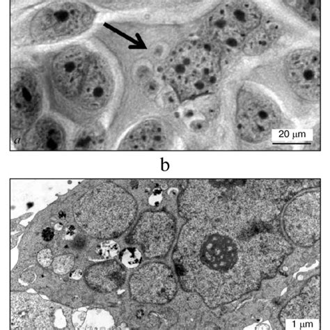 Micronuclei In Cells Of Human Mammary Gland Carcinoma Culture Mcf7