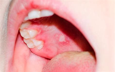 Почему появился прыщик во рту как он выглядит и как его лечить