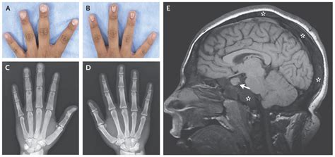 Fibrous Dysplasia Skull