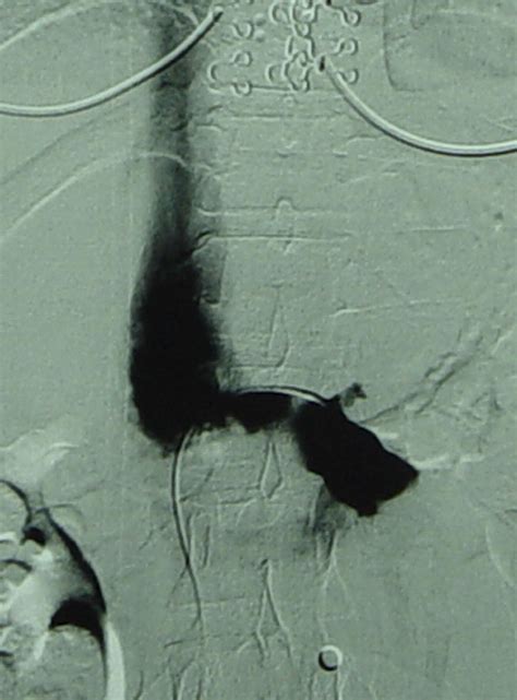 Nutcracker Syndrome Endovascular Treatment At Tim Ingram Blog