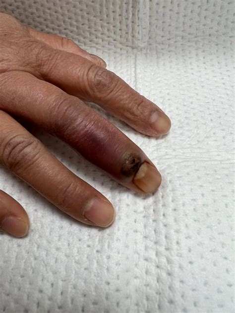 Finger Infection Around Nail