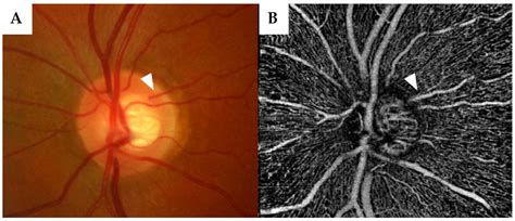 Optical Coherence Tomography Glaucoma At Trent Ragland Blog