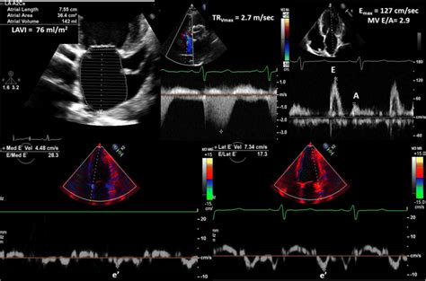 An Example Of Grade 3 Diastolic Dysfunction In A 70 Year Old Man With Download Scientific