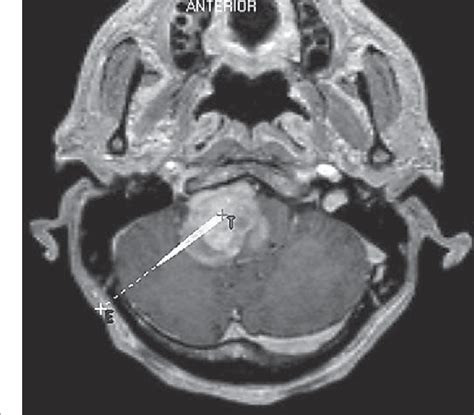 Figure 4 From Stereotactic Biopsy For Brainstem Tumors Comparison Of Transcerebellar With