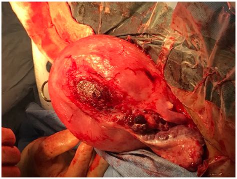 A Cornual Placenta Percreta At The Site Of Excision Of Previous Cornual