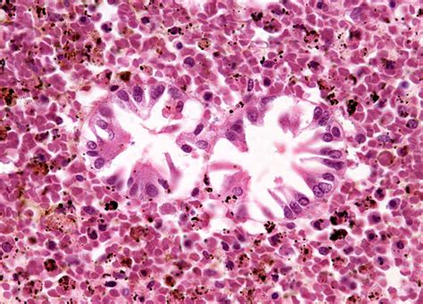 Suppurative Appendicitis At 40x Magnification Nikons Microscopyu