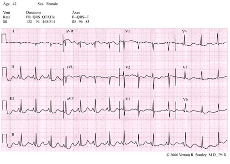 Qtc Calculator Qtc Ecg Calculator App On Amazon Appstore