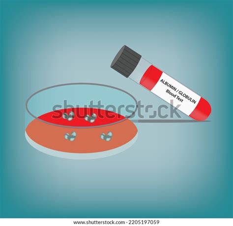 Albumin Liver Cirrhosis Over 9 Royalty Free Licensable Stock Vectors