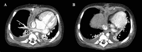 11 Thrombosis In The Conduit After The Extracardiac Tcpc A A Slice At