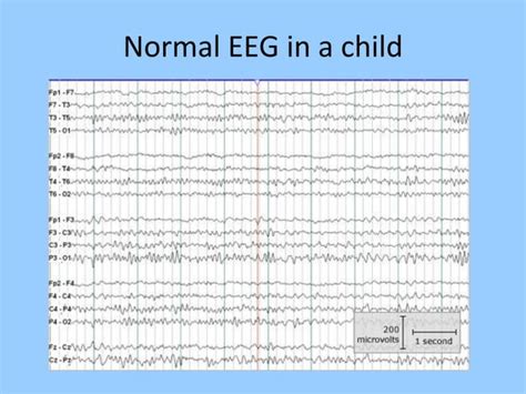 Eeg In Pediatric Dnb Pediatric Pptx Brain And Nervous System
