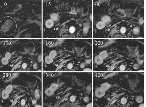 Typical Aspect Of The Contrast Enhanced Pathologic Bowel Wall In Time