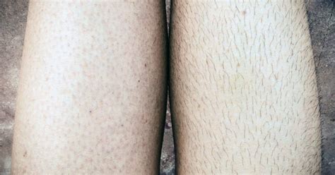 How To Get Rid Of Strawberry Legs Treatment And Prevention