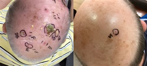 Early Signs Of Skin Cancer On The Scalp Symptoms Photos Next Steps