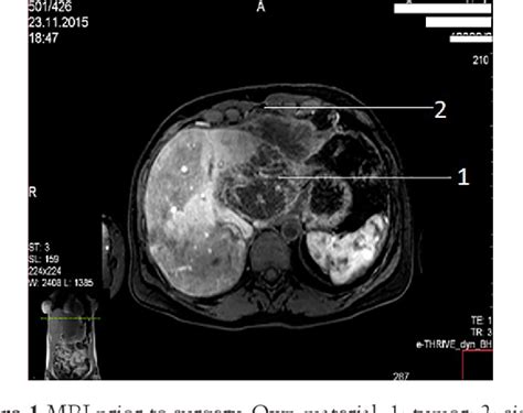 Table 1 From Personalised Approach In Combined Treatment Of Cholangiocarcinoma A Case Report Of