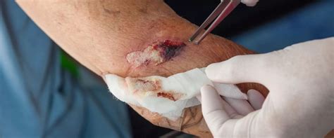 Infected Stitches Pictures With Tips To Prevent Infection
