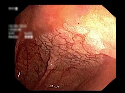 Polyp Classification Dataset And Pre Trained Model By Polyps Detection