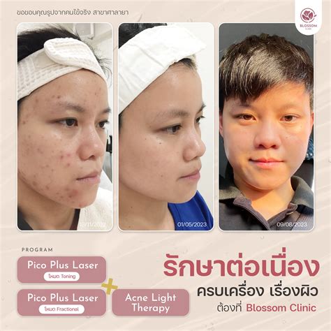 โปรแกรม Pico Laser คืออะไร ทำไมถึงยอดนิยม ลดกระ ฝ้า
