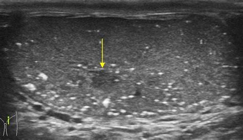 Urinary Tract And Male Reproductive System 2 3 Scrotum Case 2 3 13 Microlithiasis And