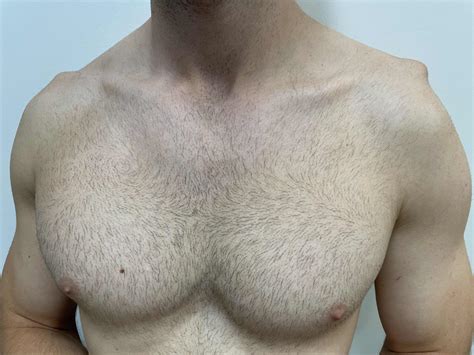 Acj Dislocation The Bone School