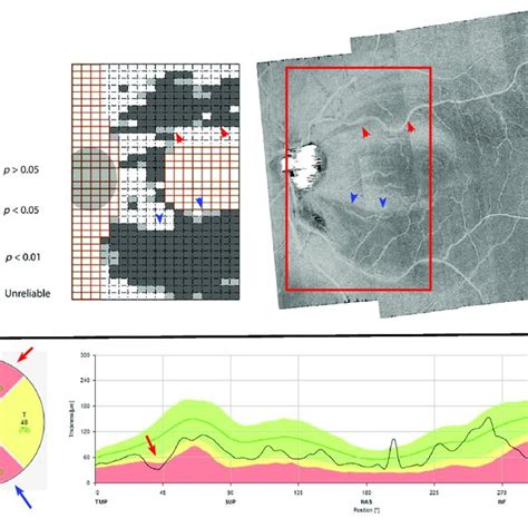 Agreement Between Circumpapillary Retinal Nerve Fibre Layer Thickness Download Scientific