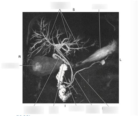 Fig 771 Mr Cholangiopancreatogram Mrcp Of Biliary System Diagram