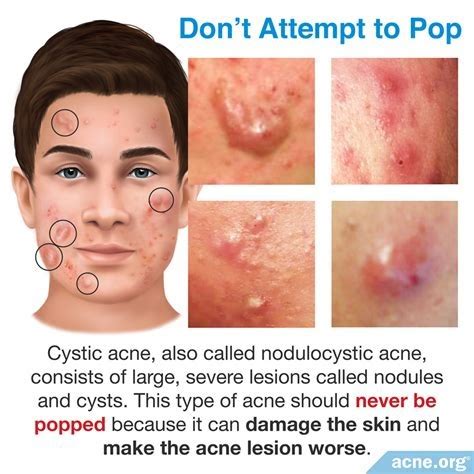 Cystic Pimple Pop Tips And Techniques For Safe And Effective Removal Dongcohopsobaumuller