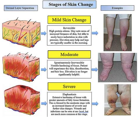 Lymphedema In Laymans Terms