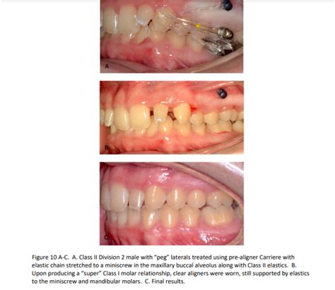 Distalization With Tad And Carriere Motion Aligner Abc