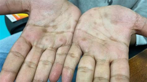 إصابة مراهق بـ الزهري بعد علاقة مع خادمة إفريقية تليجراف مصر