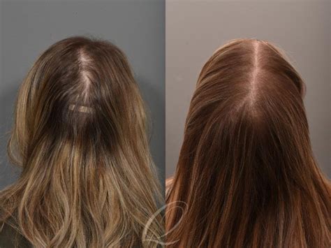 PRP Injections Before And After Photo Gallery Rochester Buffalo Syracuse NY Quatela