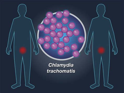 Azithromycin Or Doxycycline For Asymptomatic Rectal Chlamydia Trachomatis New England Journal